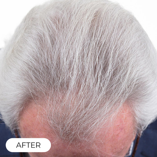 CapillusPro Hair Regrowth Laser Cap – Novera International/ Capillus