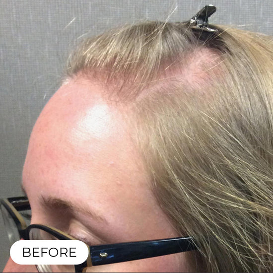 CapillusPro Hair Regrowth Laser Cap – Novera International/ Capillus