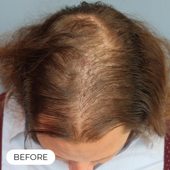 Capillus Pro S2 - Hair Regrowth Laser Cap – Novera International/ Capillus